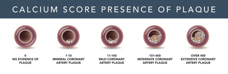 Coronary Artery Calcium Score – Kippax Medical Imaging